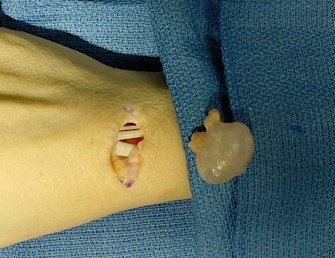 GANGLION (WRIST, HAND, FINGERS) | Hand Surgery Resource